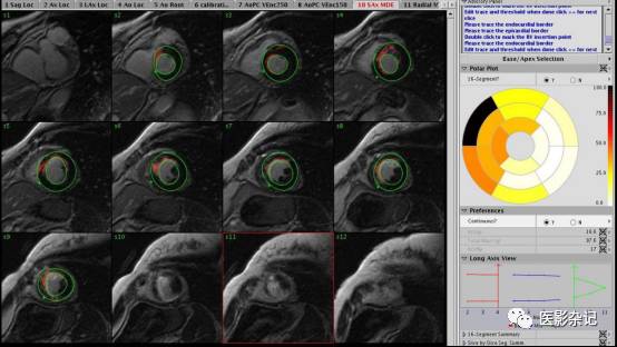 MRI影像学习笔记（三）_labelingspine-CSDN博客